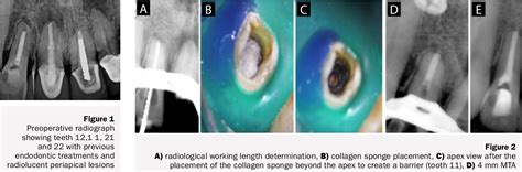 Figure 1 From Management Of Teeth With Open Apex And Apical Periodontitis Using Mta And Orthomta