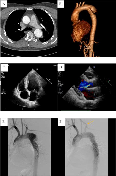 Diagnosis And Treatment Of Carotid Left Subclavian Bypass Graft