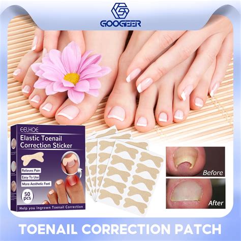 Eelhoe Elastic Toenail Correction Stickers Ingrown Toenail Corrector