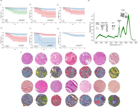 Prediction Of Post Treatment Recurrence In Early Stage Breast Cancer Using Deep Learning With