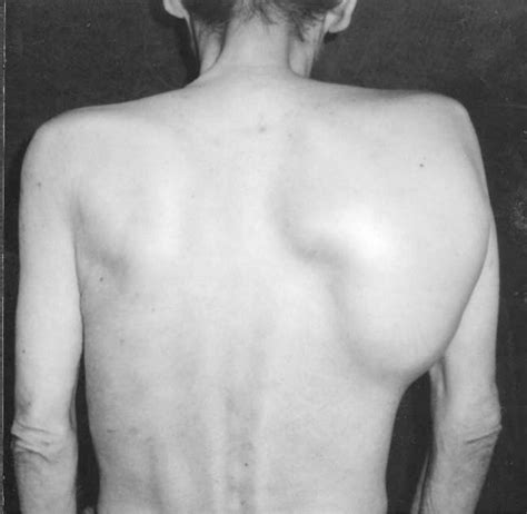 Figure 1 From Large Chest Wall Abscess Due To Microaerophilic