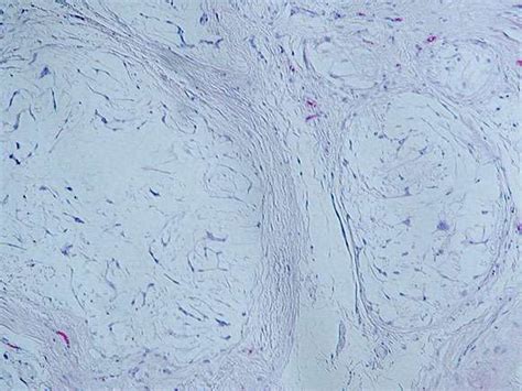 Appendix Enterobius Infection Bosnianpathology