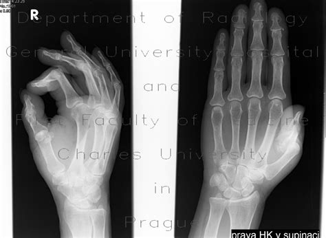 Radiology Case Dislocation Of The First Interphalangeal And