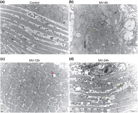 Morphologic Abnormalities Of Mitochondria And Autophagy In The