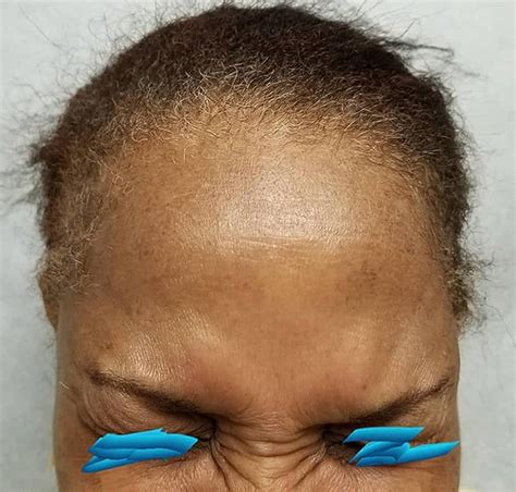 neurotoxin aglow dermatology