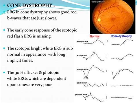 Erg And Eog Pptx Eye And Vision Conditions Diseases And Conditions