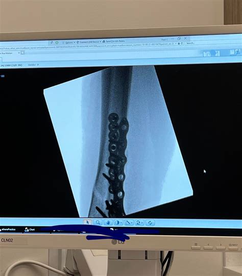 4 Weeks Post Op After Orif Surgery For Pilon Fib Tib Fracture Really Nervous About Full