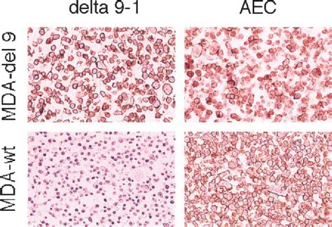 Figure 1 From Analysis Of E Cadherin In Diffuse Type Gastric Cancer