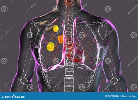 Pulmonary Blastomycosis 3d Illustration Stock Illustration