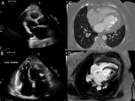 Rare Cause Of Ventricular Calcification Heart