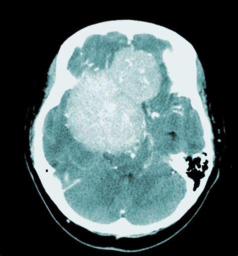 Ct Brain Axial Scans Hyperdense Mass With Homogeneous And Mild
