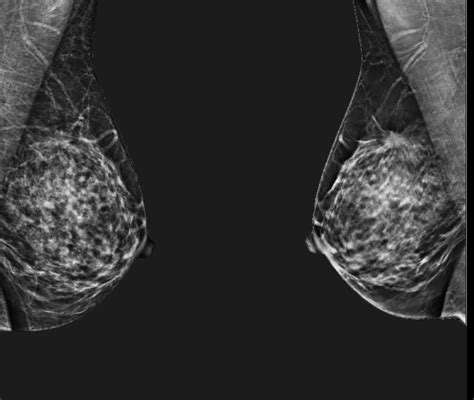 Ge Mammography Systems Applications Solutions Experiences Ge Healthcare United Kingdom