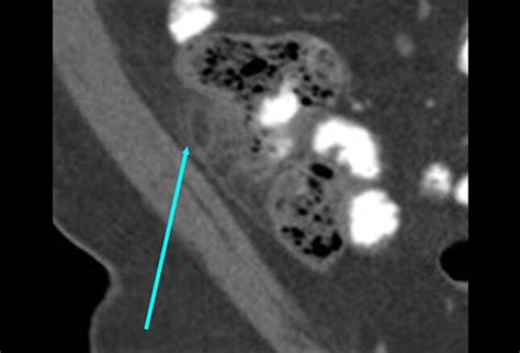 14 Mimics Of Appendicitis
