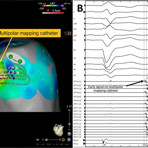 A High Density Endocardial Left Ventricular Activation Map With The Download Scientific Diagram
