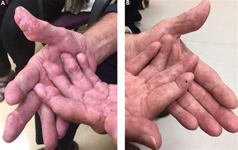 Osteoarthritis Finger Nodules