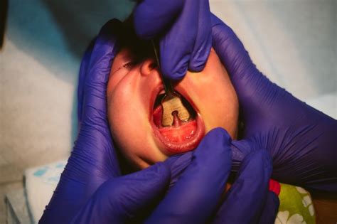 Lip And Tongue Ties Impact Dr N Garcia Demartino