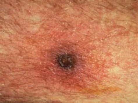 Indian Researchers Find Combination Antibiotic Treatment For Severe Scrub Typhus A Public Health