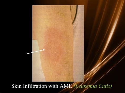 Acute Leukemia Ppt