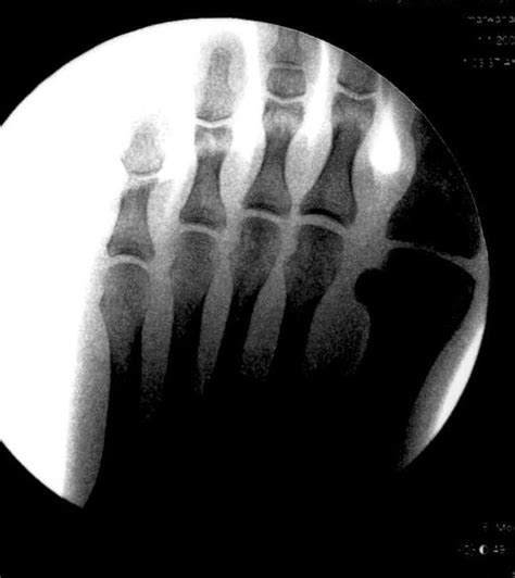 Any Difference R Xrays