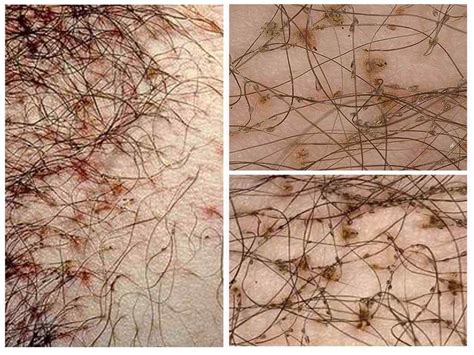 Как выглядят вши и гниды фото вшей в волосах человека