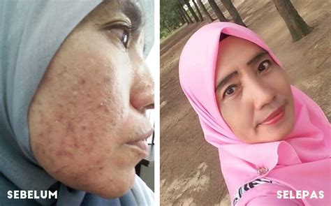 Stress Dengan Kulit Wajah Breakout Teruk Gadis Ini Pilih Almas