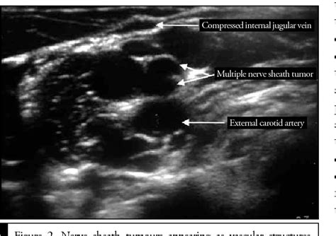 External Jugular Vein Ultrasound