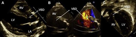 Preoperative Tte Demonstrating A Large Perimembranous Vsd With Left