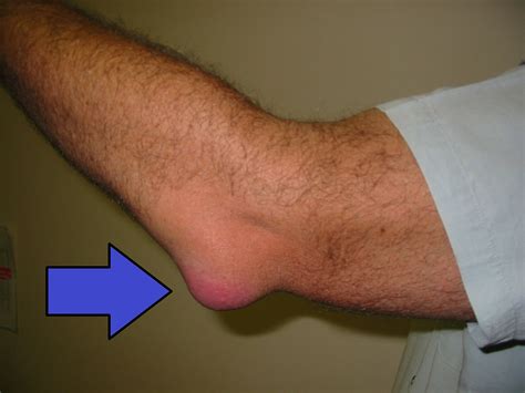Olecranon Bursitis Diagnosis And Treatment