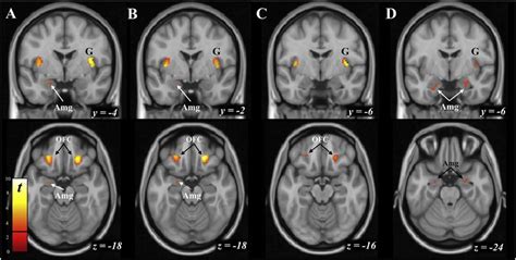 Increased Bold Responses Of The Primary Gustatory Cortex In The Dorsal