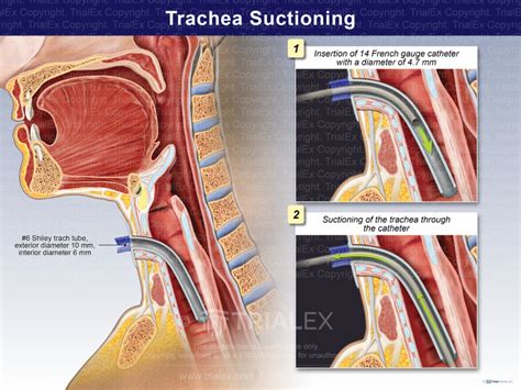 Tracheal Suctioning Trialquest Inc