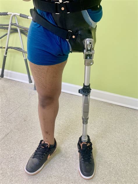 Hip Disarticulation And Hemipelvectomy Amputees Human Tech