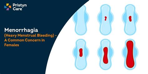 Excessive Menstrual Bleeding