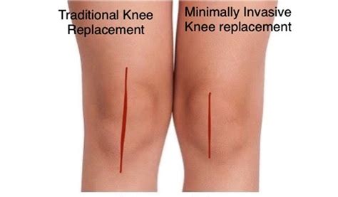 Partial Knee Replacement Scar