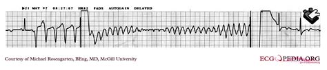 Artificial Pacemaker Wikidoc