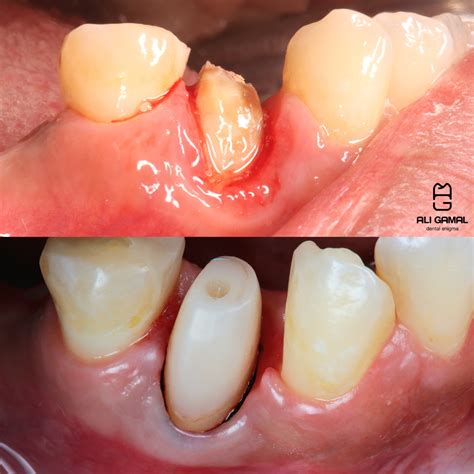 Biologically Oriented Tooth Preparation Technique Bopt Myzerodonto