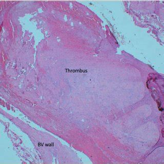 Organized Thrombus With Fibroblastic Proliferation And Download