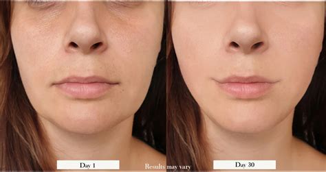 Nuderma Wand Does It Really Work Doctors Opinion Reviews