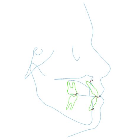 Analyse Céphalométrique En Tunisie Smart Clinic