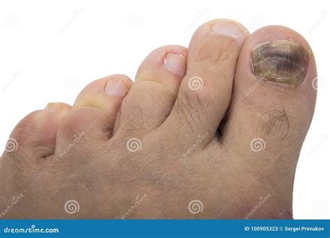 Toenail Fungus Or Melanoma