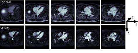 Figure 1 From Evaluation Of An Open Source Pipeline To Create Patient Specific Left Atrial