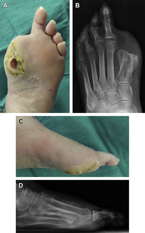 Partial Foot Amputations For Salvage Of The Diabetic Lower Extremity Clinics In Podiatric Partial Foot Amputations For Salvage Of The Diabetic Lower Extremity Clinics In Podiatric