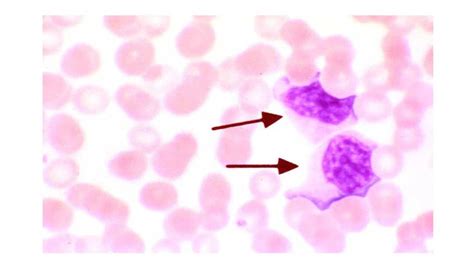 Causes Of Atypical Lymphocytes Reactive Lymphocytes