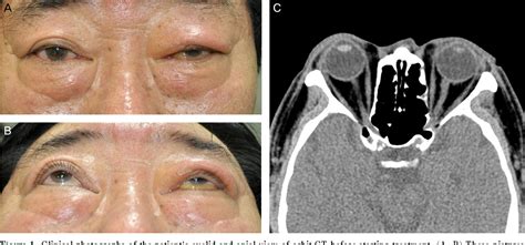Figure 1 From A Case Of Idiopathic Upper Eyelid Swelling Treated By