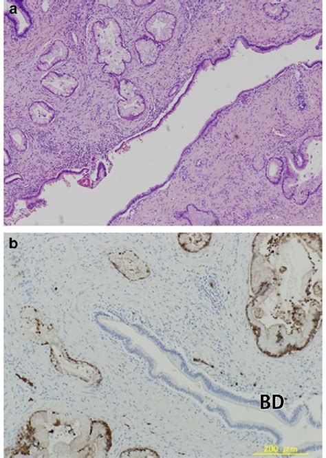 Histopathologic Findings Of Cholangiocarcinoma Of Periductal Spread Download Scientific Diagram