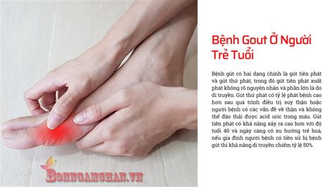 Bệnh Gout Ở Người Trẻ Tuổi Nguyên Nhân Gây Ra Bệnh Gout