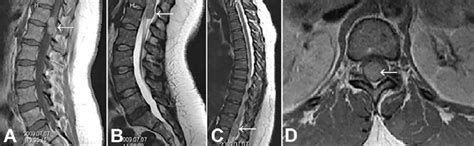 Sagittal T1 Weighted Post Contrast Magnetic Resonance Imaging Mri Of