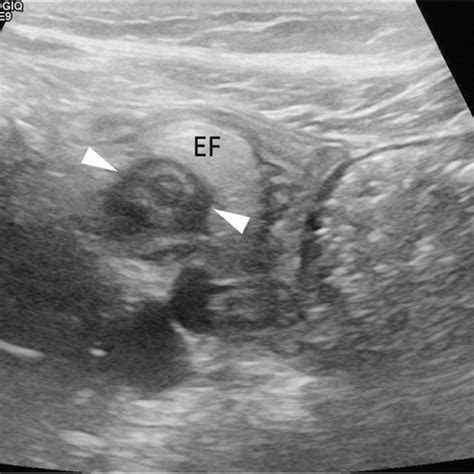 Transverse Ultrasound Image Shows A Normal Appendix Cursors In A