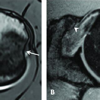 Conventional Radiographs Of The Shoulder A Anteroposterior Ap View
