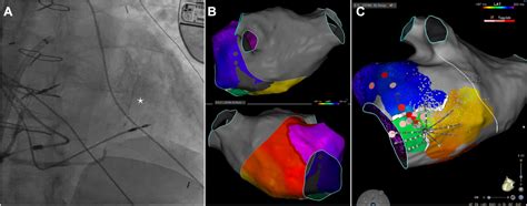 Ethanol Infusion Into The Vein Of Marshall Of A Transplanted Heart Canadian Journal Of Cardiology