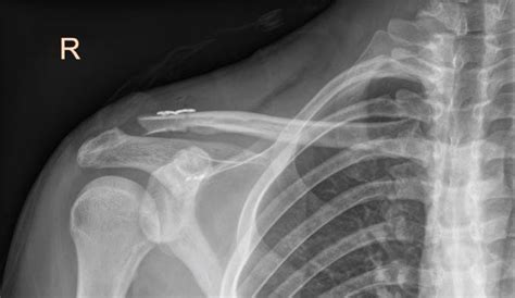 Acromioclavicular Joint Dislocation Treatment Clinical Evaluation And
